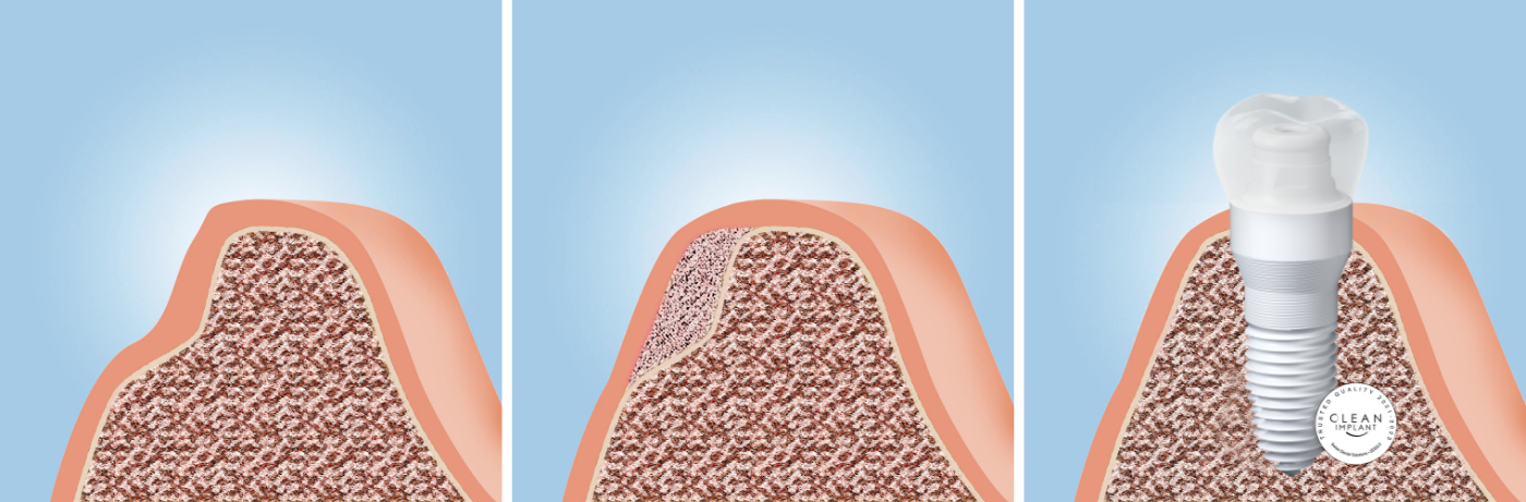 Knochenaufbau - Oralschirurgie am Klinkerberg